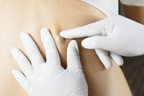 Cysts & Bumps - Welcome to Vanguard Dermatology - Vanguard Dermatology ...